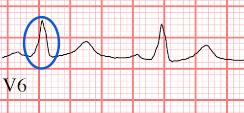 Teaching Medicine - Tutorial: Bundle Branch Blocks
